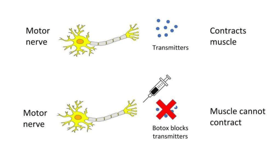 Botox for Migraine: How Does It Work and How Effective Is It ...